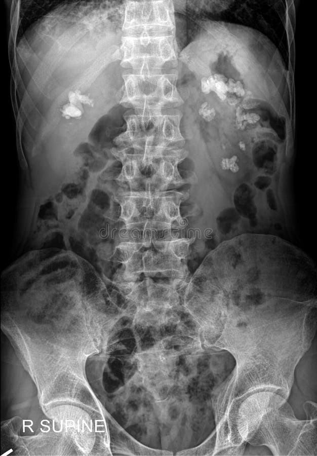 KUB Radiograph Showing Bilateral Kidney Stones Stock Photo - Image of ...