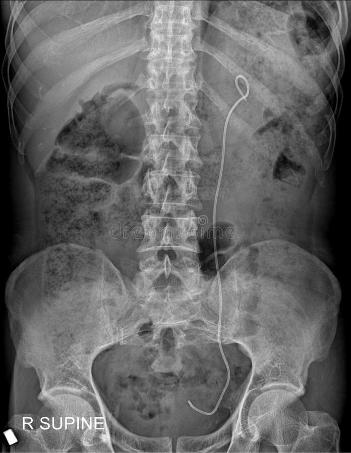 KUB X-ray Imaging with Stent Placement: Precise Radiographic Analysis ...