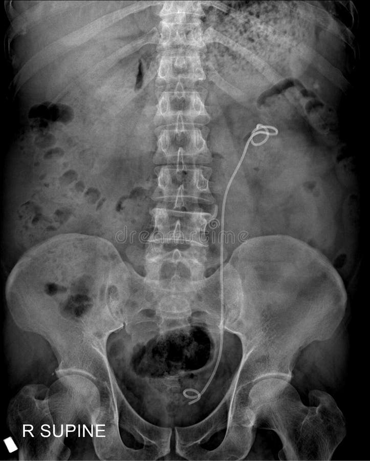 KUB X-ray Imaging with Stent Placement: Precise Radiographic Analysis ...