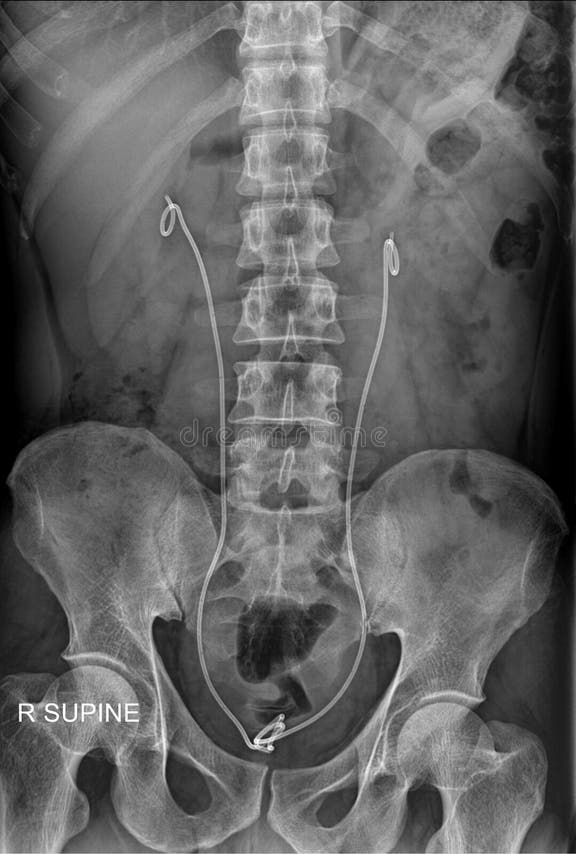 KUB X-Ray: Visualization of Left-Sided Double J Stent from Kidney To ...