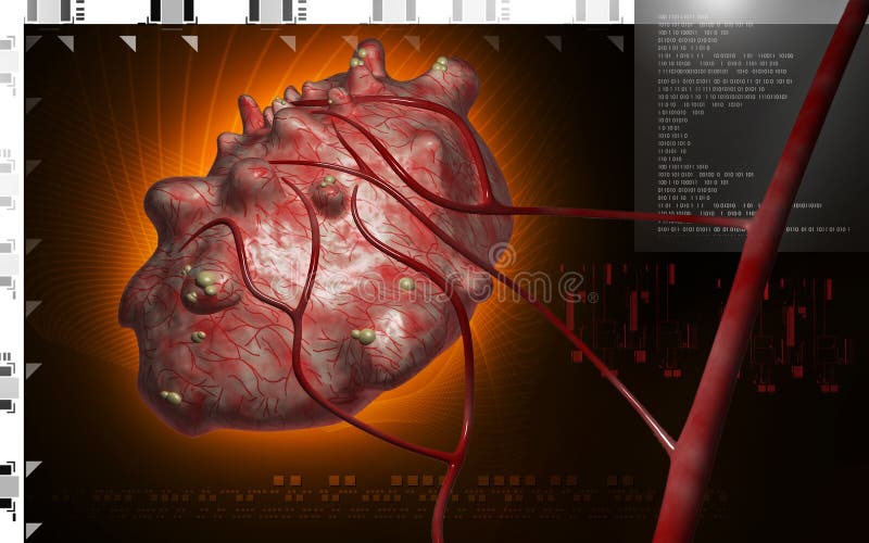 Kyste ovarien illustration de vecteur. Illustration du fonctionnel ...