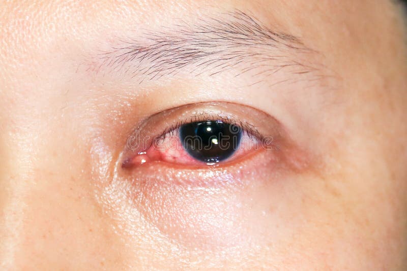 L'oeil a Une Infection Et Une Conjonctivite Image stock - Image du ...