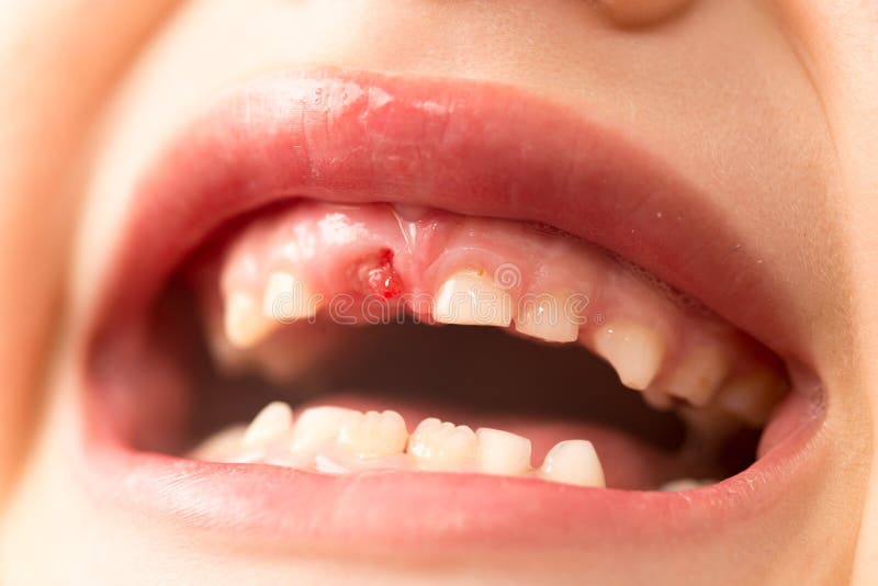 La Boca De Un Muchacho Sin Un Diente Imagen de archivo - Imagen de cara ...