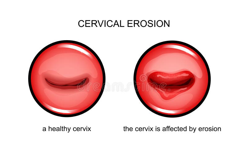 La Cerviz Es Afectada Por La Erosión Ilustración del Vector ...
