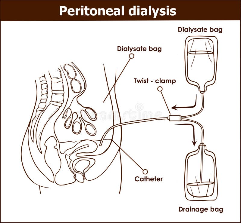 Dialyse Péritonéale Illustration De Vecteur Illustration Du Espace