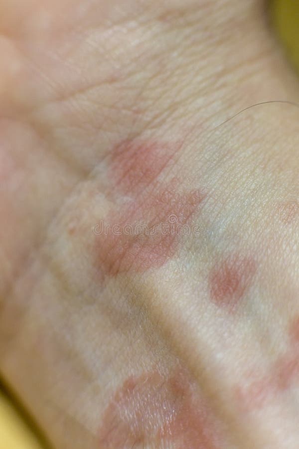 La Maladie De La Peau Sur La Dermatite De Mains Image stock - Image du ...