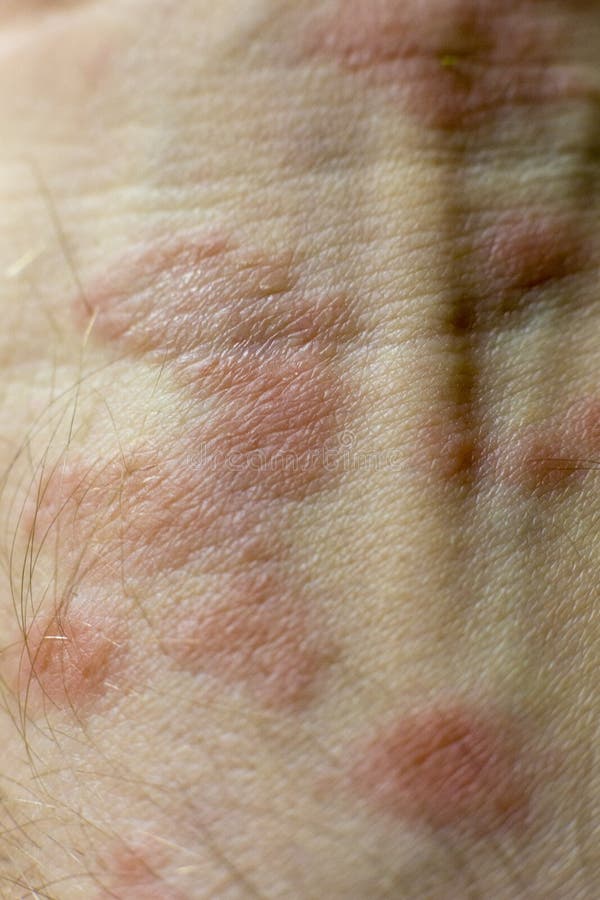 La Maladie De Peau Photos Stock - Téléchargez 9,239 Photos libres de droits