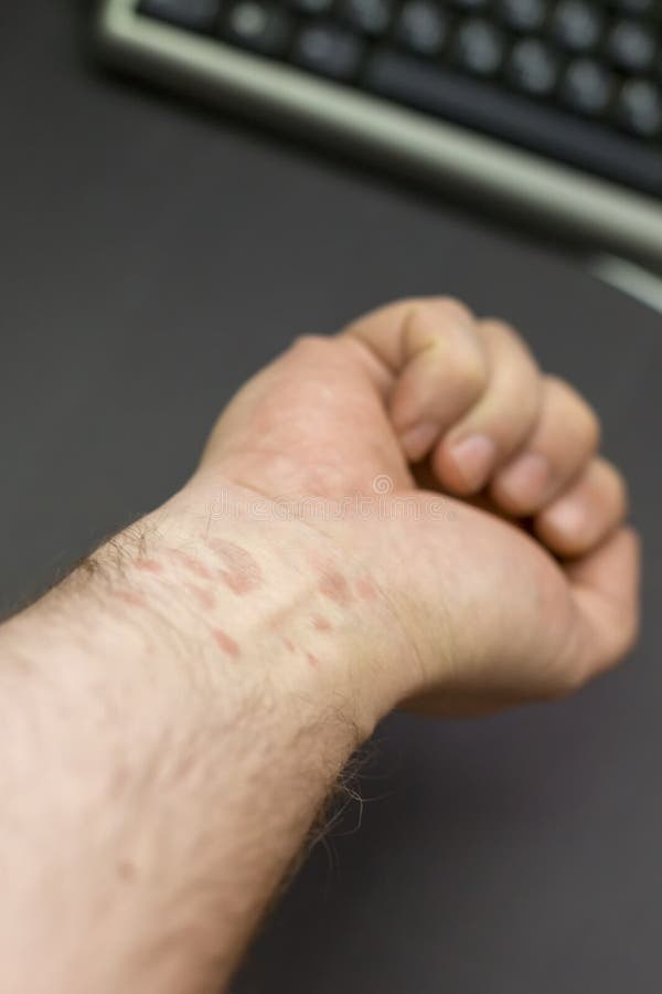 La Maladie De La Peau Sur La Dermatite De Mains Image stock - Image du ...