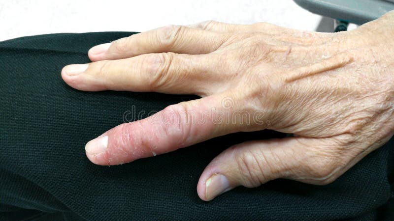 Hombre Con La Piel Infectada En La Cara Imagen de archivo - Imagen de ...