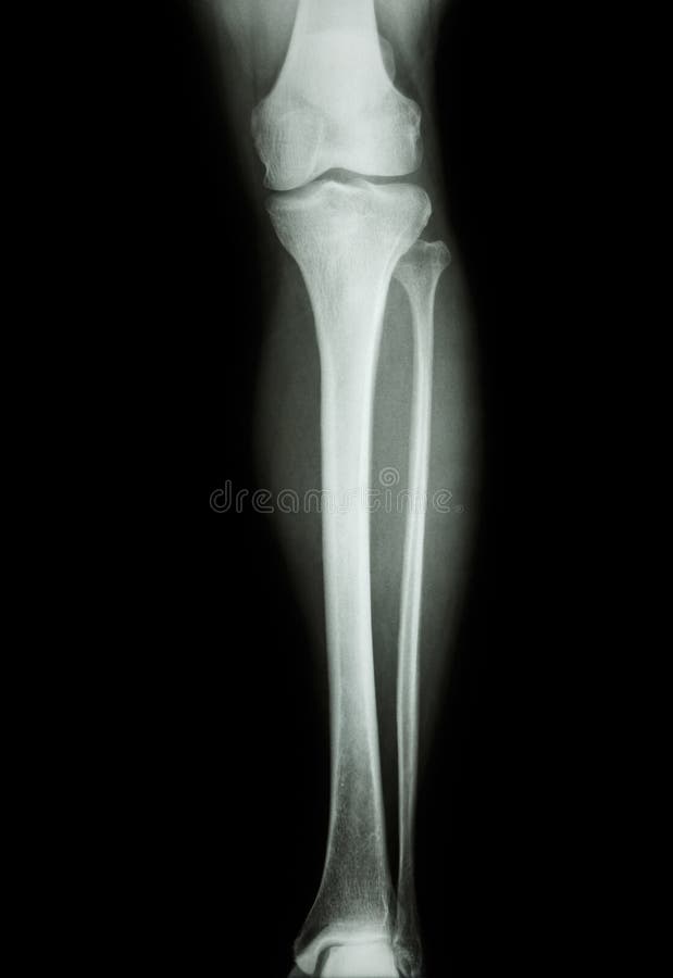 La Pierna Normal Del Ser Humano Foto de archivo - Imagen de hospital ...