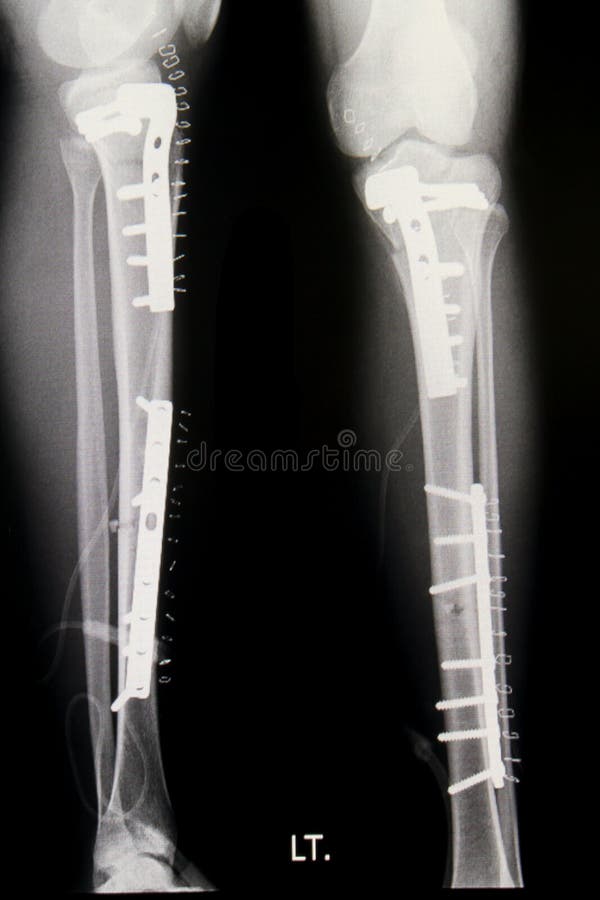 La Pierna Radiografía Imagen Imagen de archivo - Imagen de fondo ...