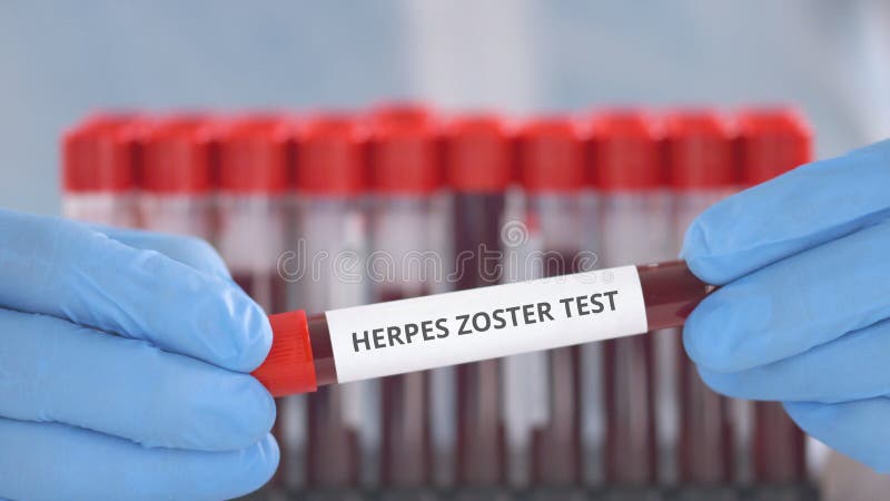 Laboratory Assistant Wearing Protection Gloves Holds Vial with Herpes ... Laboratory Assistant Wearing Protection Gloves Holds Vial with Herpes ...
