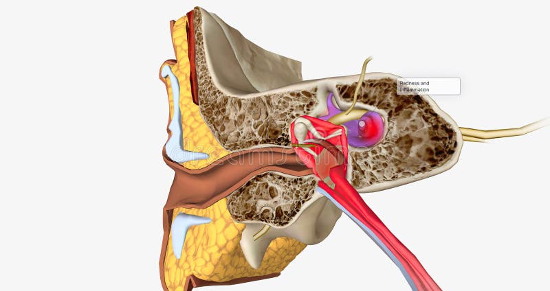 Labyrinthitis is an Infection and Inflammation of the Inner Ear and the ...