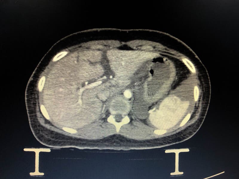 Laceración Del Hígado Con Hemoperitonium Foto de archivo - Imagen de ...