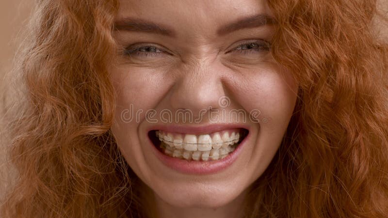 Lady with Braces Smiling Snapping Teeth Posing Over Beige Background ...