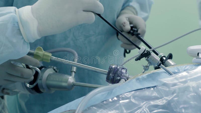 Laparoscopic Surgery of the Abdomen Stock Photo - Image of procedure ...