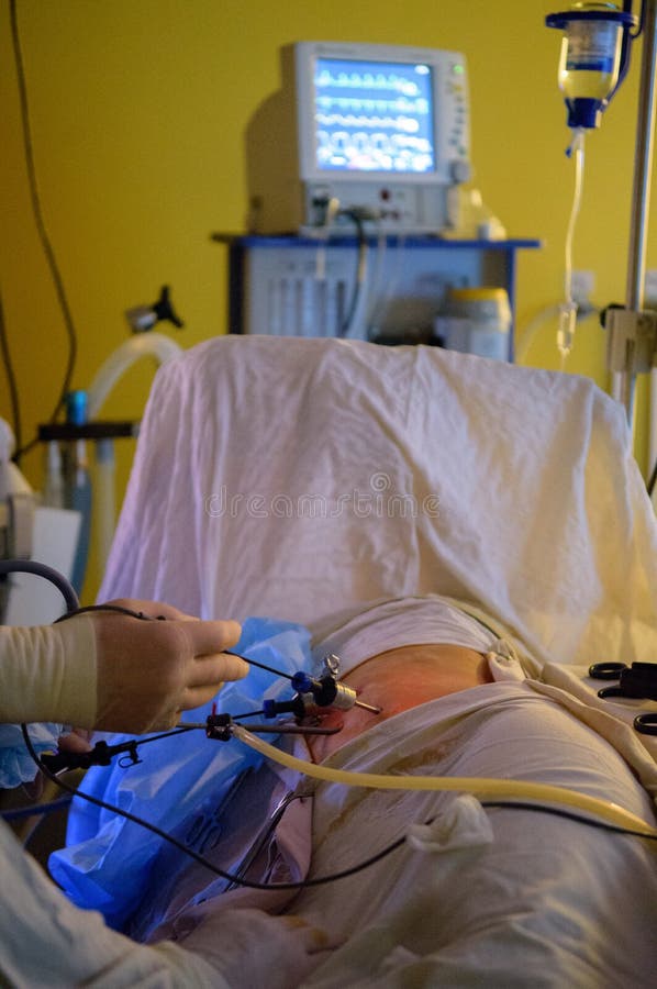 Laparoscopic Surgery Operation Stock Image - Image of laparoscopy ...