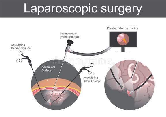 Laparoscopic Cholecystectomy Surgery Stock Illustrations – 11 ...