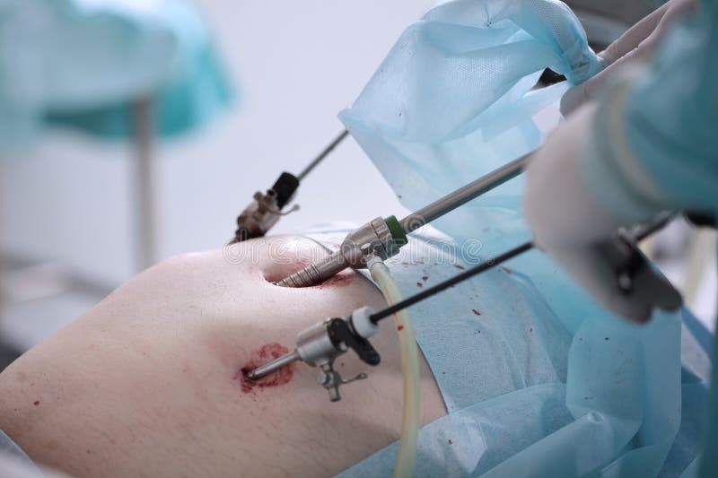 Laparoscopy in Surgery. Surgery in the Abdominal Cavity through Small ...