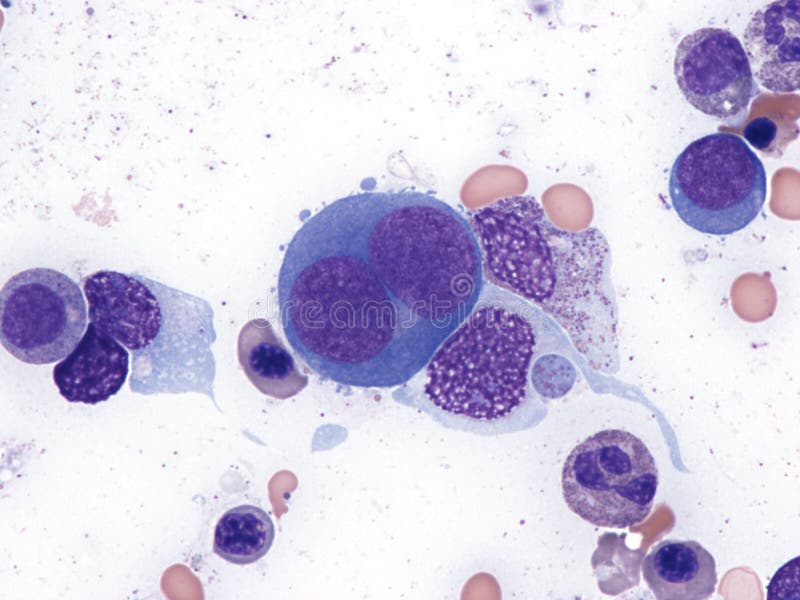 Myelodysplastic syndrome. stock illustration. Illustration of medical ...