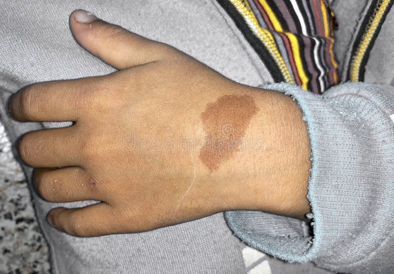 Large Birthmark with Irregular Shape on Hand. Dark Colored Patch Stock ...