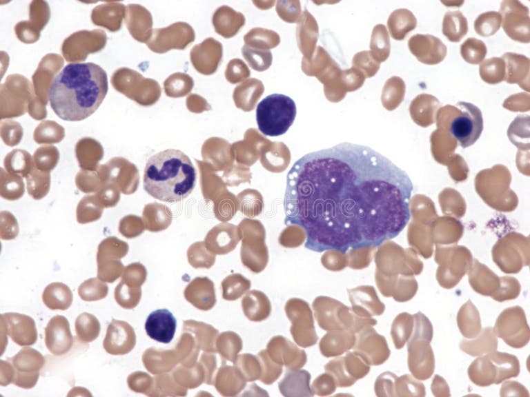 Large Blast in Acute Monocytic Leukemia. Stock Image - Image of ...