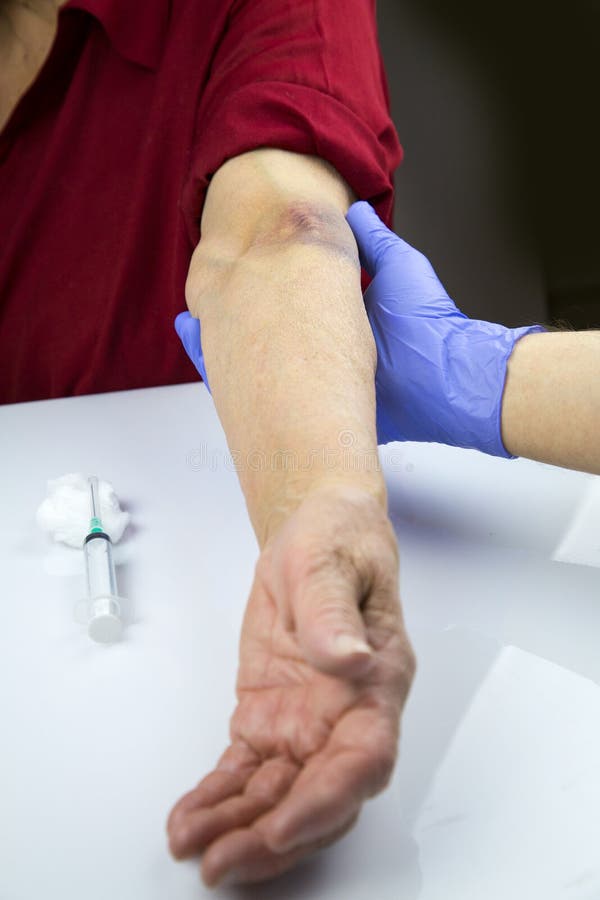 Large bruise on human arm stock photo. Image of skin - 52499412