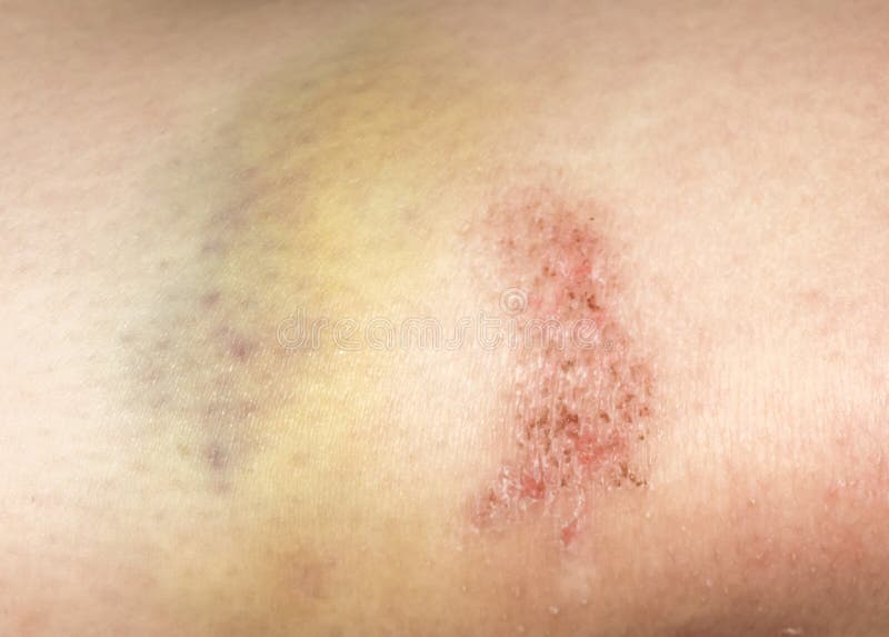 Large Bruises and Abrasions on Human Skin. Stock Image - Image of skin ...