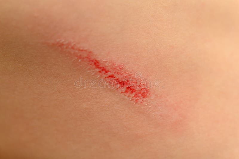 Large Cut on the Leg. Skin Abrasion Stock Photo - Image of forehead ...