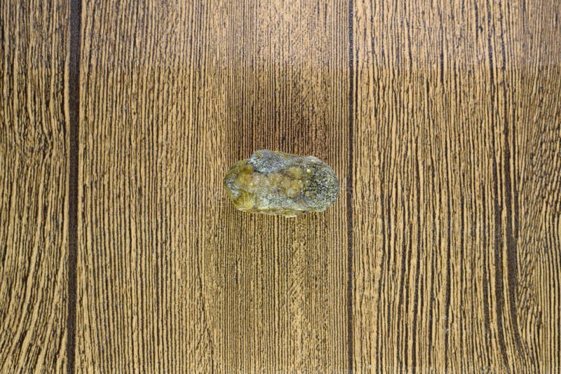 Large Gallstone, Gall Bladder Stone. Result of Gallstones. Calculus of ...