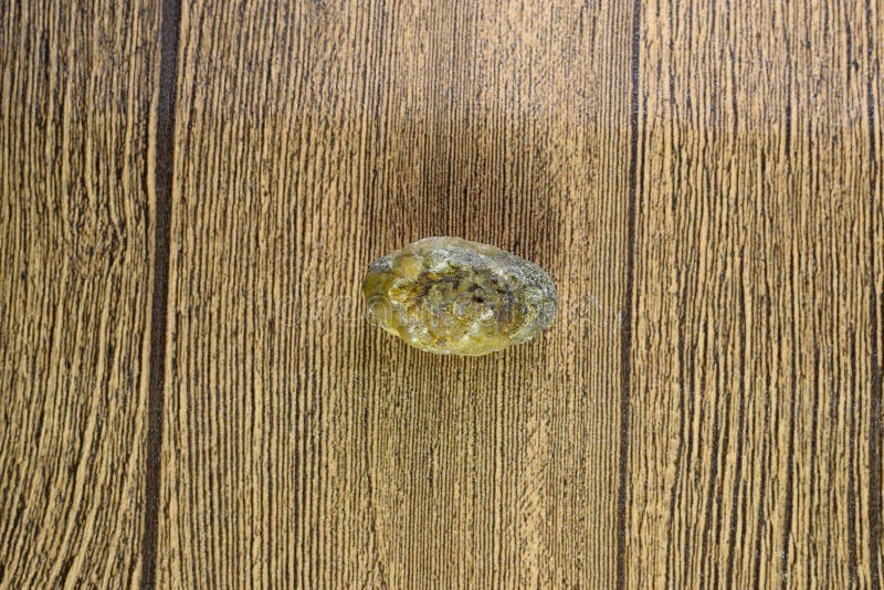 Large Gallstone, Gall Bladder Stone. Result of Gallstones. Calculus of ...