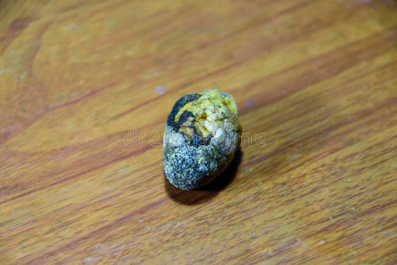 Gall Bladder Stone, Schematic Depiction, Large Sized Gallstone, Result ...