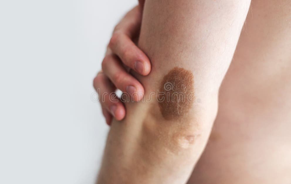 Large Hairy Nevus on Arm about Elbow of Man, Space for Text Stock Photo ...