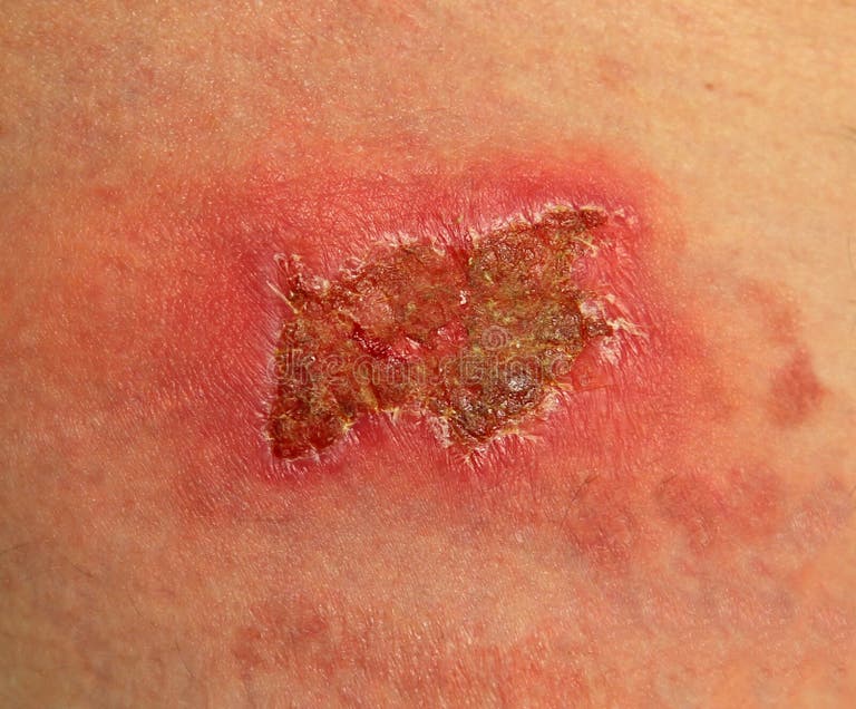 Large Healing Scab stock image. Image of scarring, injury - 40213163