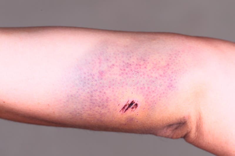 Large Hematoma on Human Arm Stock Photo - Image of extreme, ache: 43609386