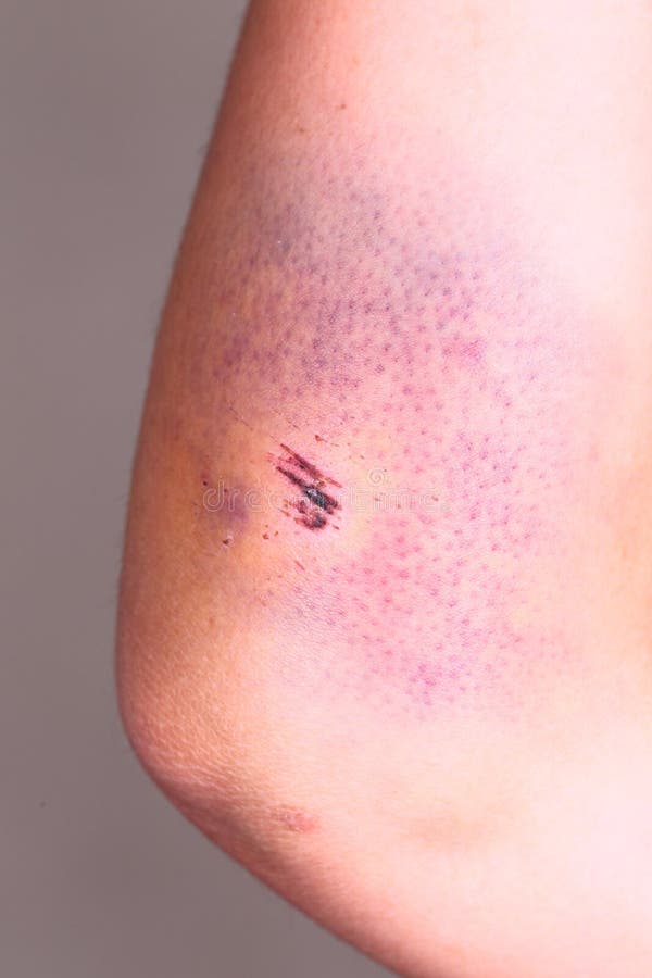 Large Hematoma On Human Arm Stock Image - Image of scratch, crash: 43609367