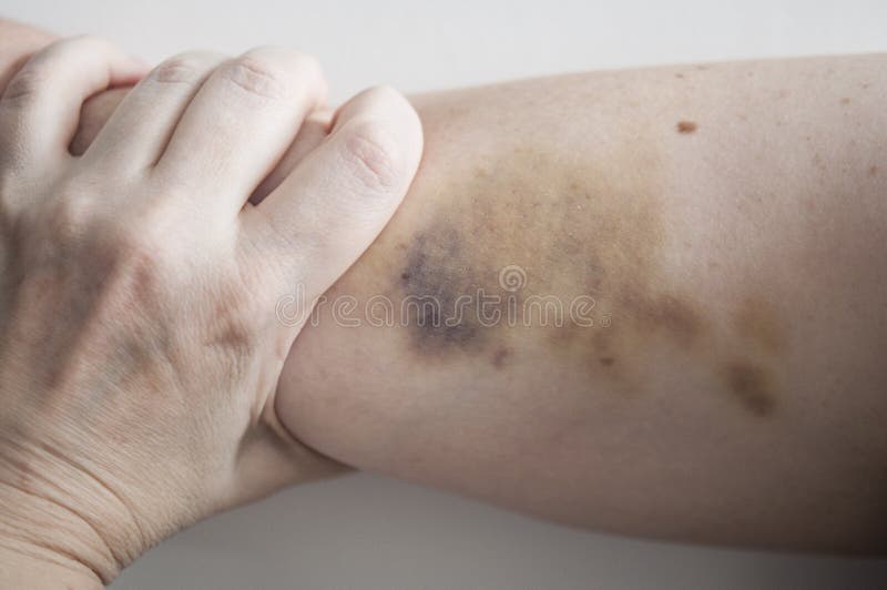 Large Hematoma on Human Arm Stock Photo - Image of contusion, skin ...