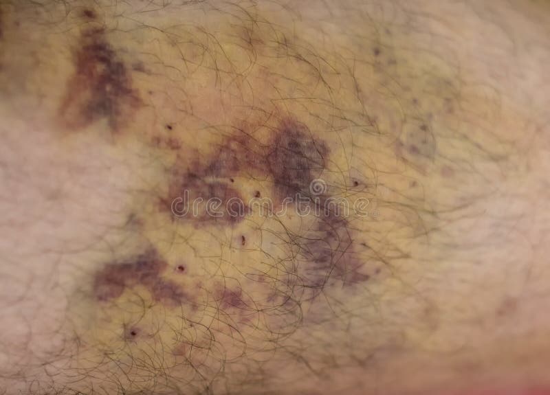 Large Hematoma on the Leg after a Medical Operation. Stock Photo ...