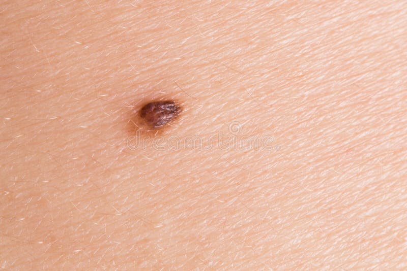 Large Mole, Close-up, Medicine, Health Stock Image - Image of benign ...