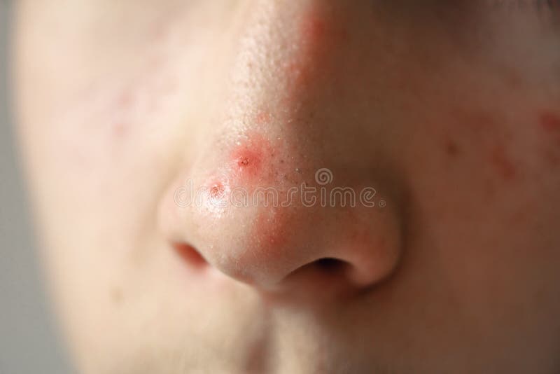Red Pimple On Nose