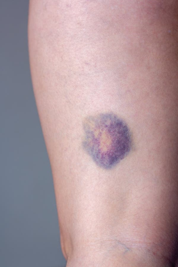 Large Round Bruise on the Leg. Stock Photo - Image of caucasian ...