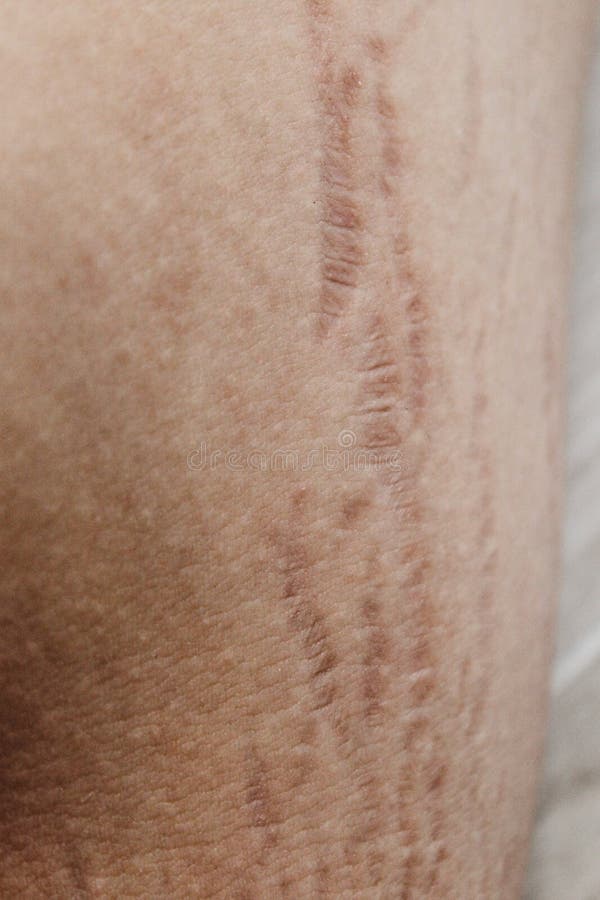 Large Stretch Marks on the Body Close-up Stock Photo - Image of ...