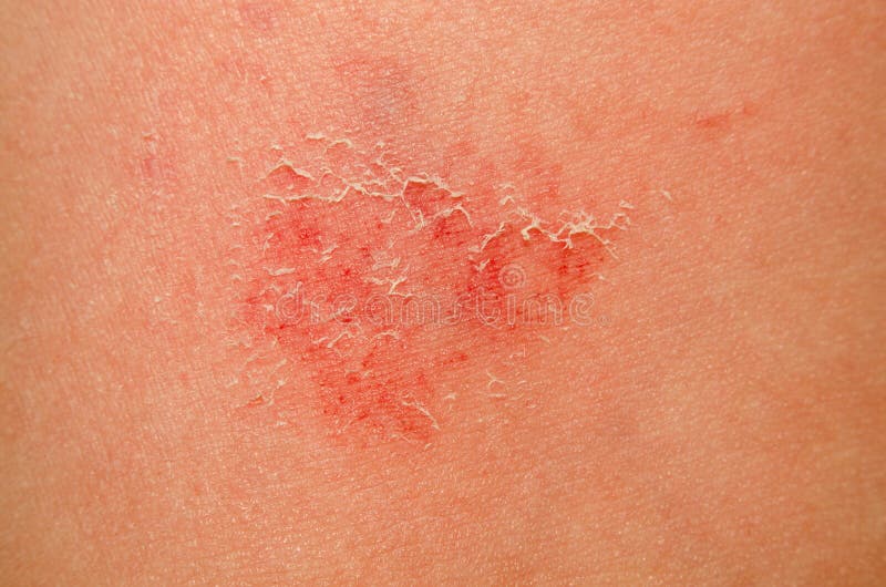 A Large Wound on the Skin of a Child Close-up Stock Image - Image of ...