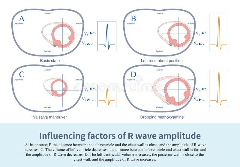 Influencing Factors of R Wave Amplitude Stock Image - Image of rhythm ...