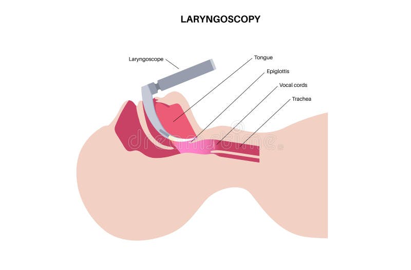 Laryngoscopy Medical Procedure Stock Vector - Illustration of clinical ...