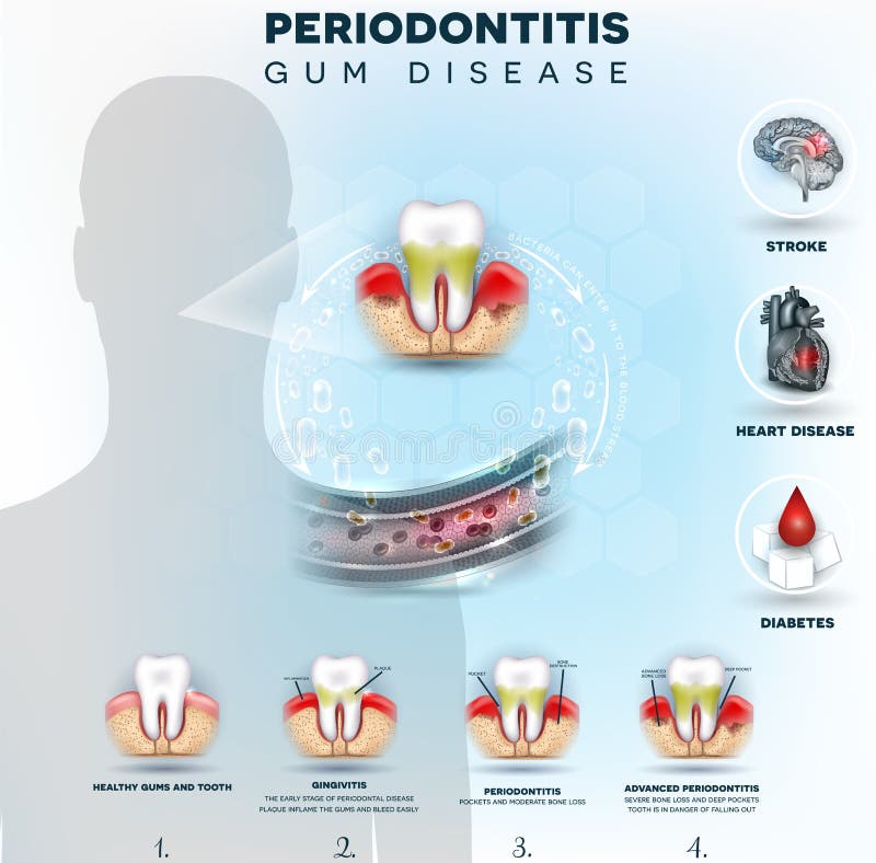 Póster Dental De Periodontitis Ilustración del Vector - Ilustración de ...