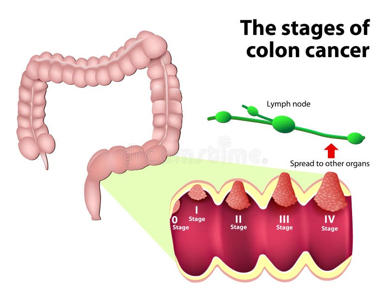 Las Etapas Del Cáncer Colorrectal Ilustración del Vector - Ilustración ...