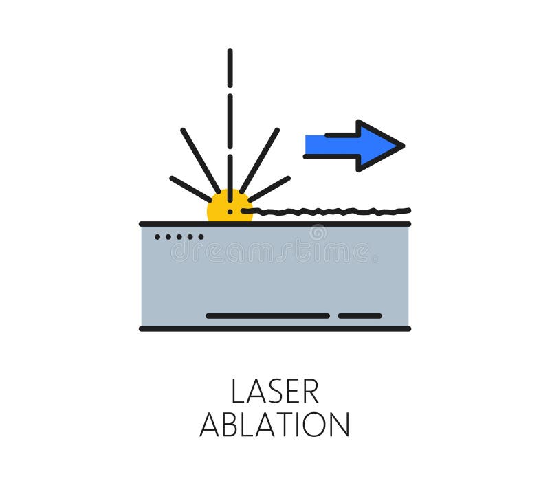 Photoablation Stock Illustrations – 1 Photoablation Stock Illustrations ...