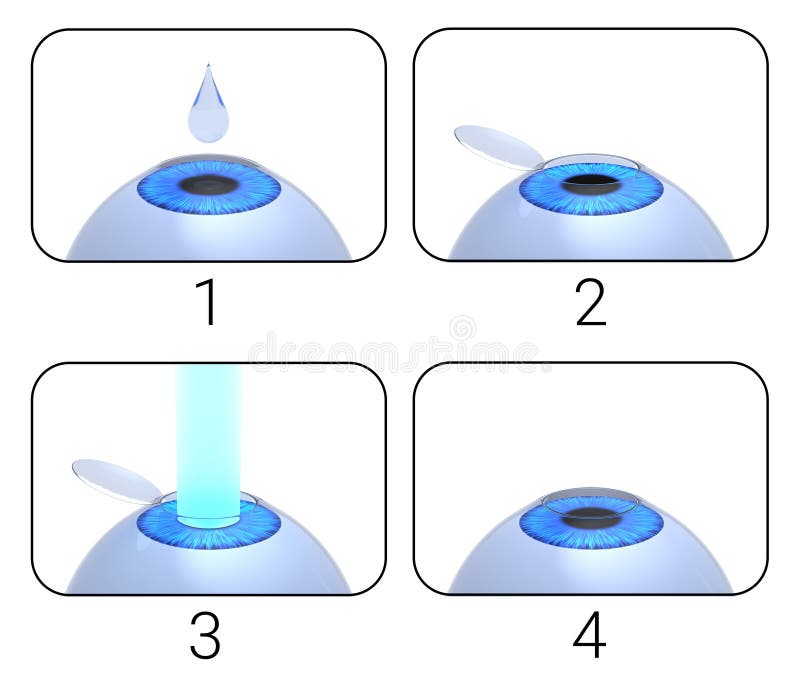 Laser Eye Surgery Procedure. 3D-rendering. Stock Illustration ...