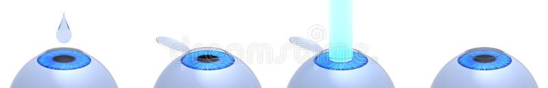 Laser Eye Surgery Procedure. 3D-rendering. Stock Illustration ...